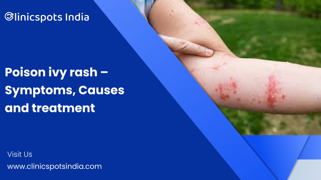 Poison Ivy Rash- ရောဂါလက္ခဏာများ၊ အကြောင်းရင်းများနှင့် ကုသမှု ...